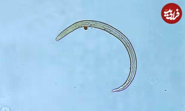 (تصاویر) عجیب‌ترین انگل‌هایی که در بدن انسان پیدا شدند؛ از خرمگس تا کرم چشم